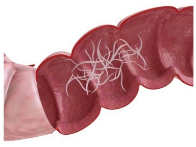 Gli ossiuri, i parassiti intestinali che colpiscono adulti e bambini e ...